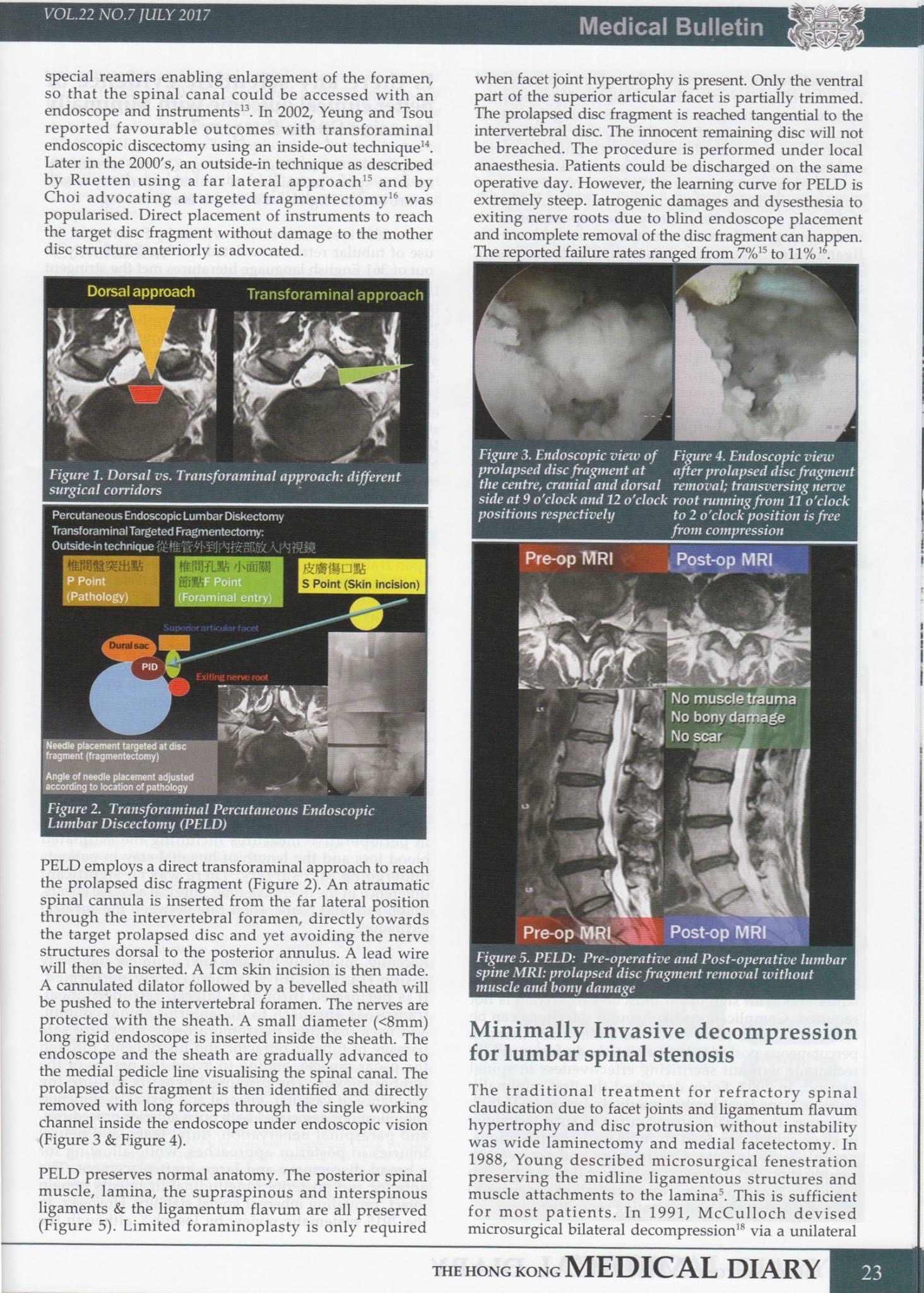 History and development of lumbar minimally invasive spinal (MIS ...